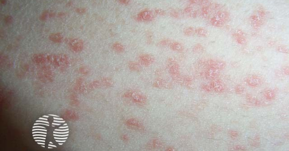 Guttate psoriasis image