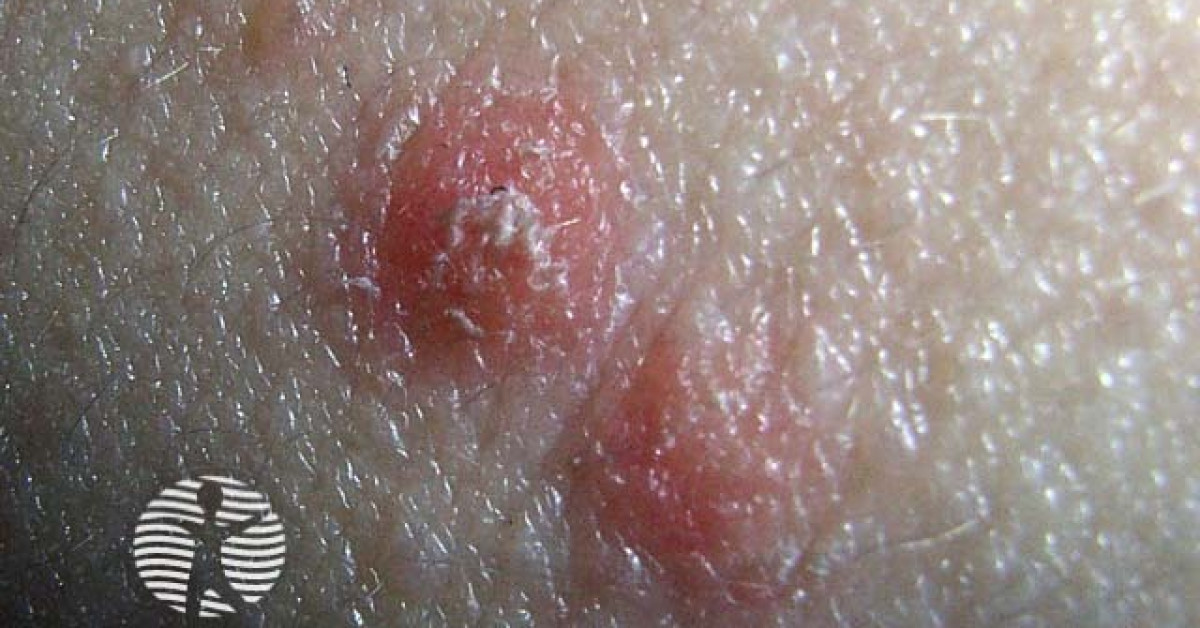 Guttate psoriasis image