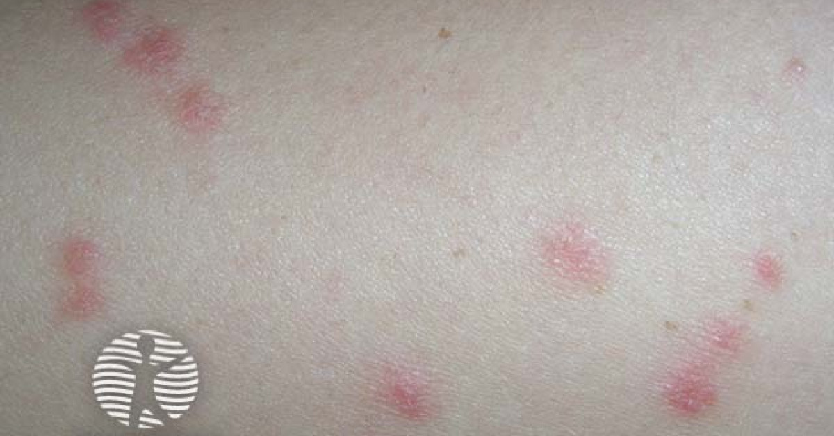 Guttate psoriasis image
