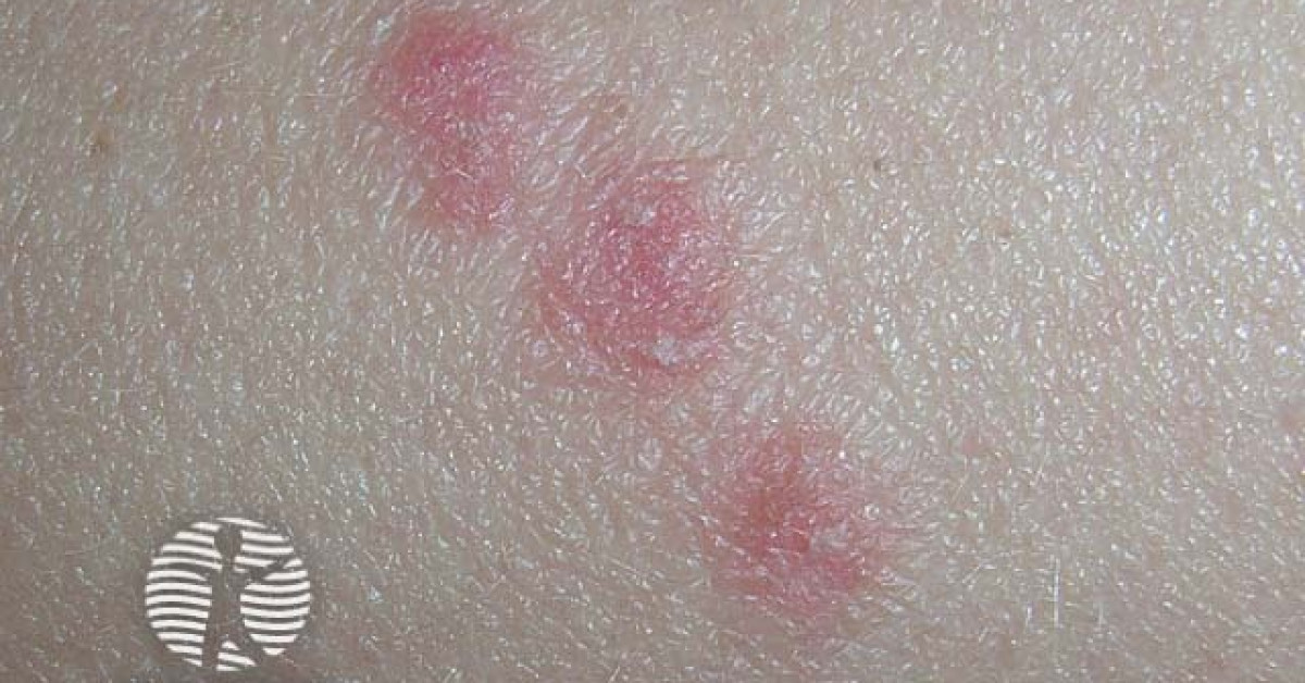 Guttate psoriasis image