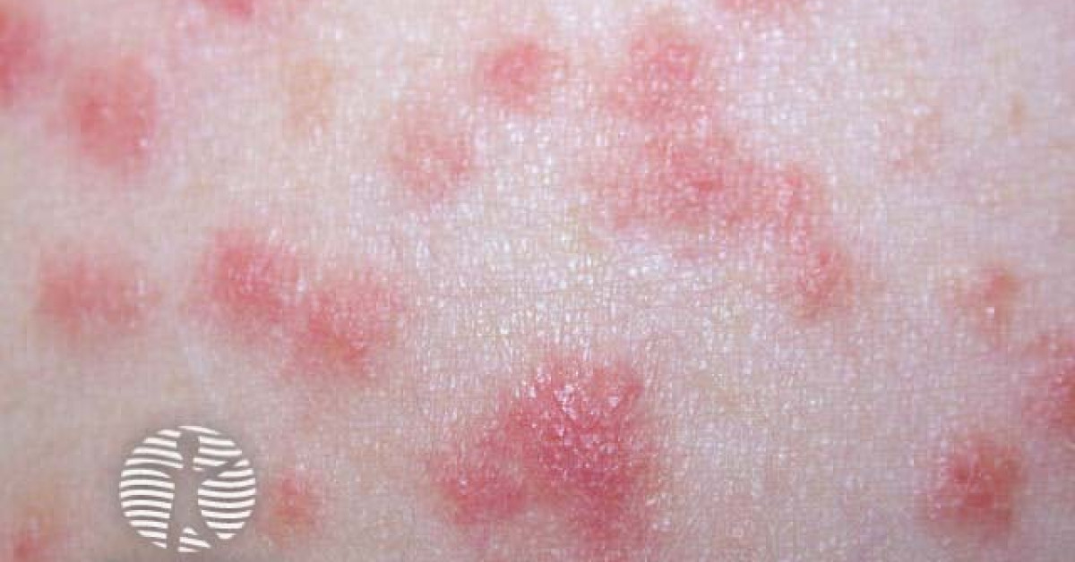 Guttate psoriasis image