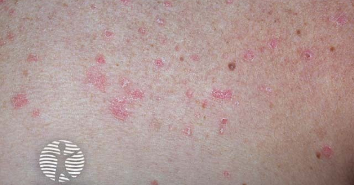 Guttate psoriasis image