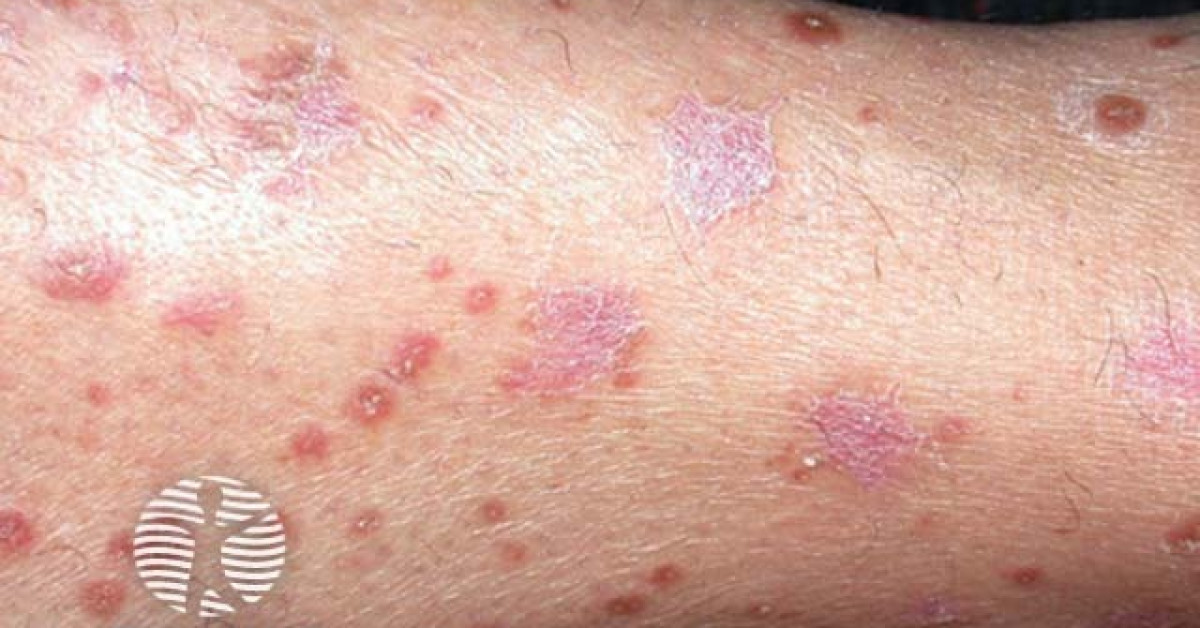 Guttate psoriasis image