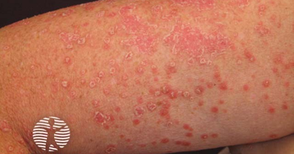 Guttate psoriasis image