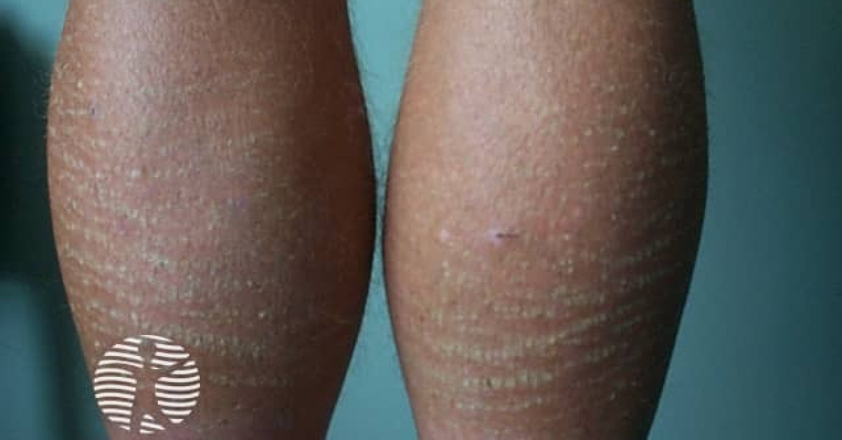Ichthyosis image