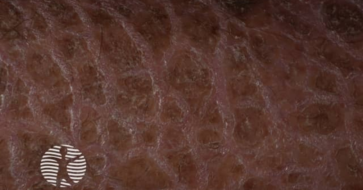 Ichthyosis image