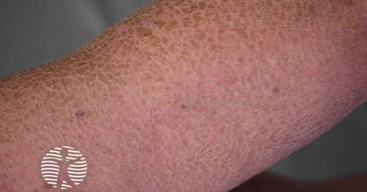 Ichthyosis image