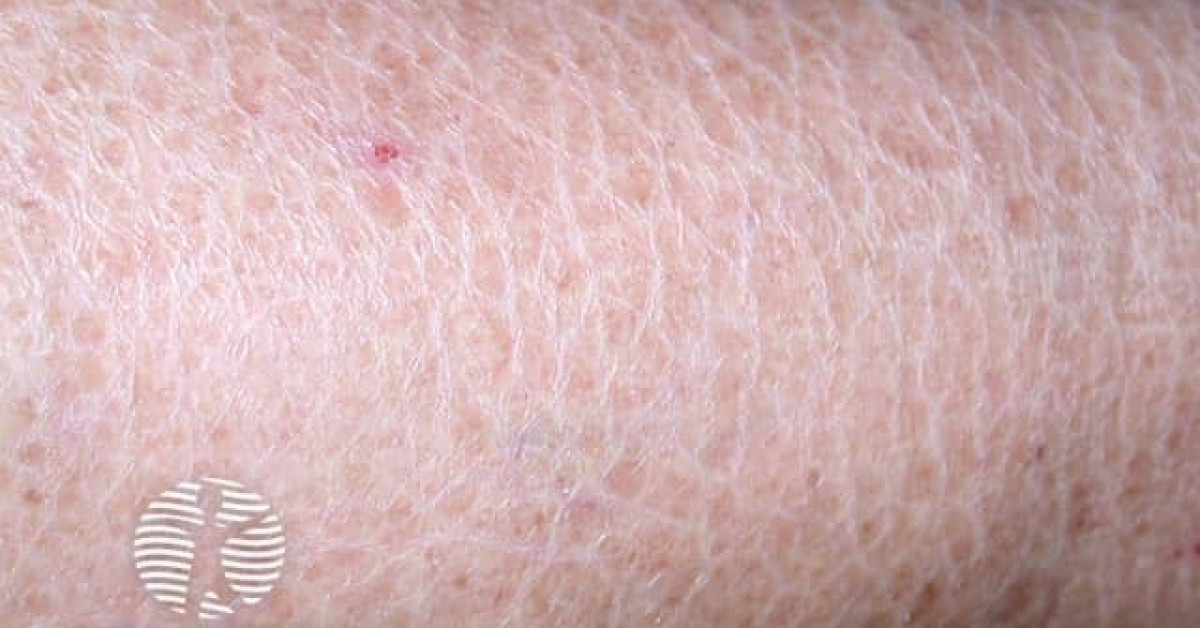 DermNet® - Ichthyosis image