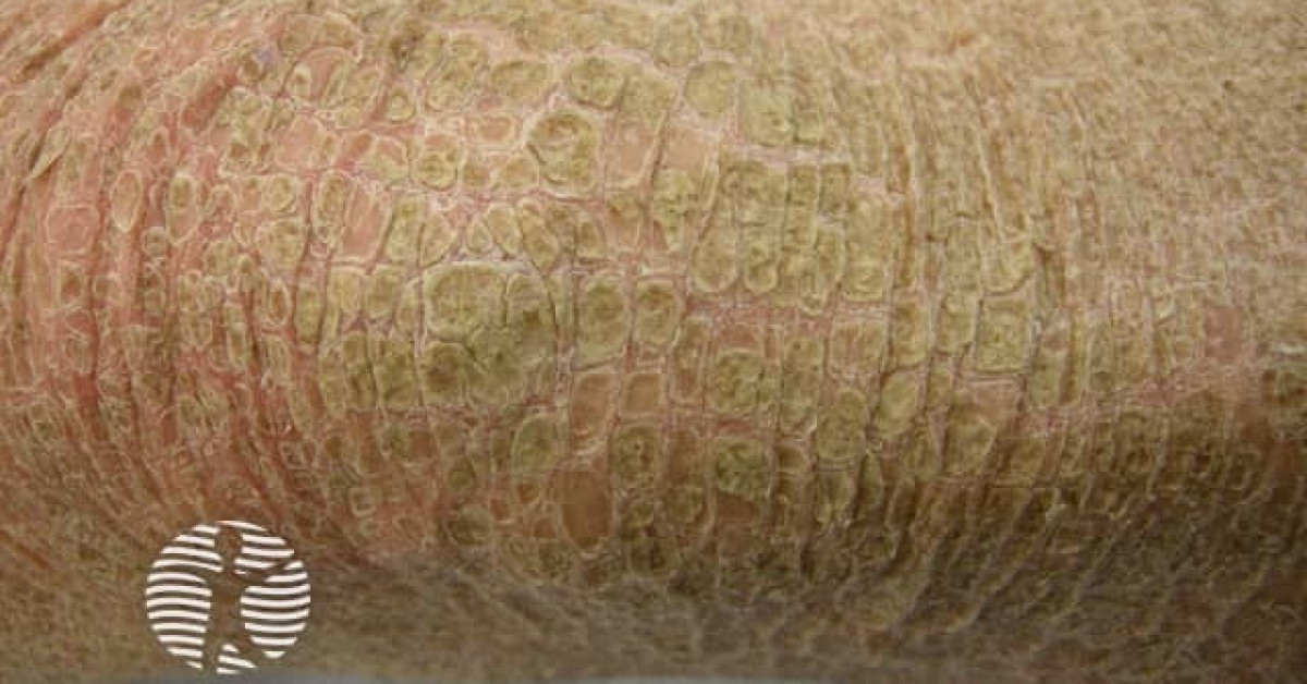Ichthyosis image