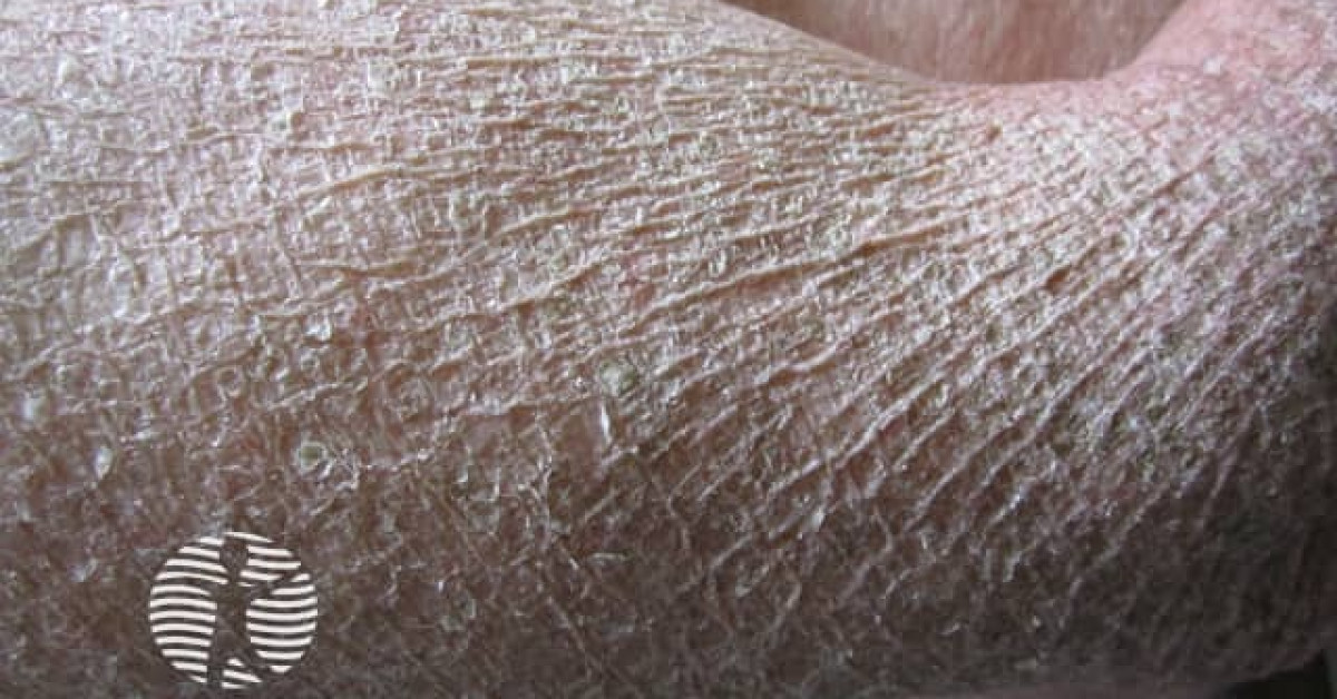 Ichthyosis image
