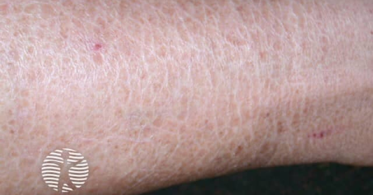 ichthyosis image