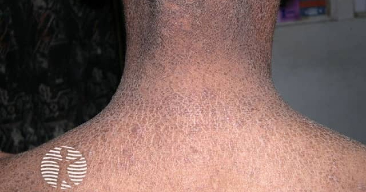 DermNet® - ichthyosis image