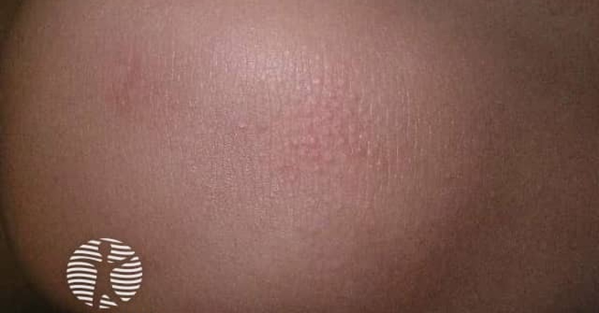 Keratosis circumscripta image