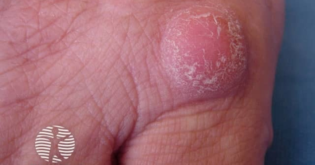 Knuckle pads image