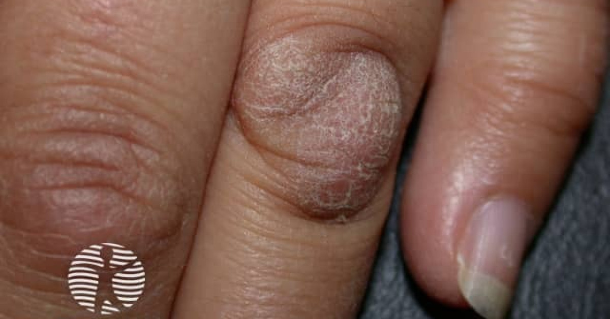 Knuckle pads image