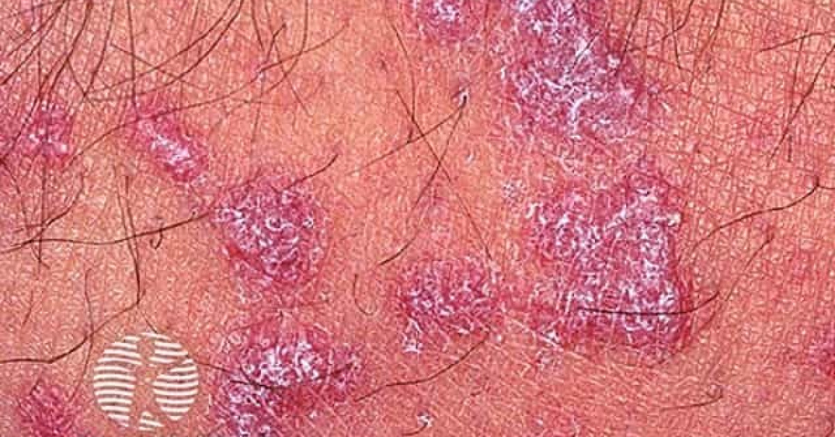 Lichen planus image