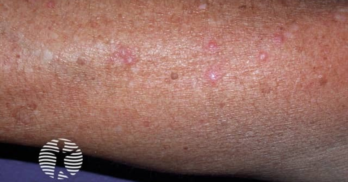 Lichen planus image