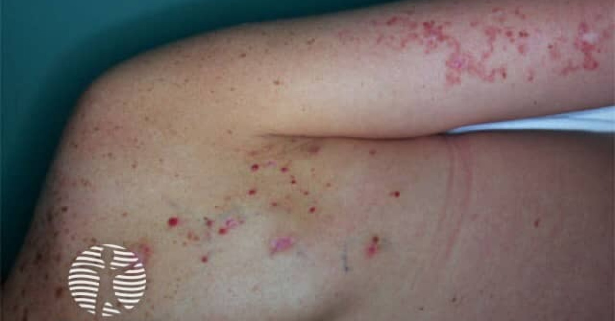 Linear porokeratosis image