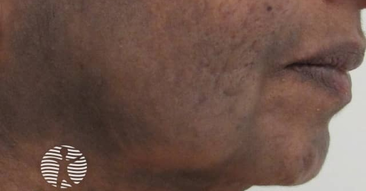 Lichen planus pigmentosus of face image