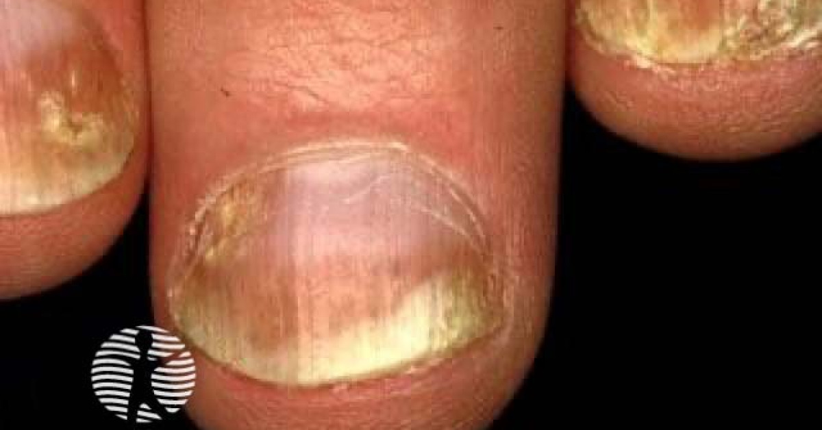 Nail psoriasis image