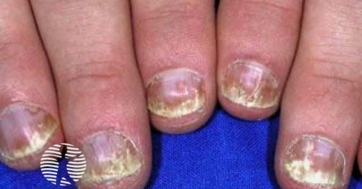 Nail psoriasis image