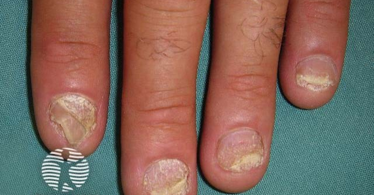Nail psoriasis image
