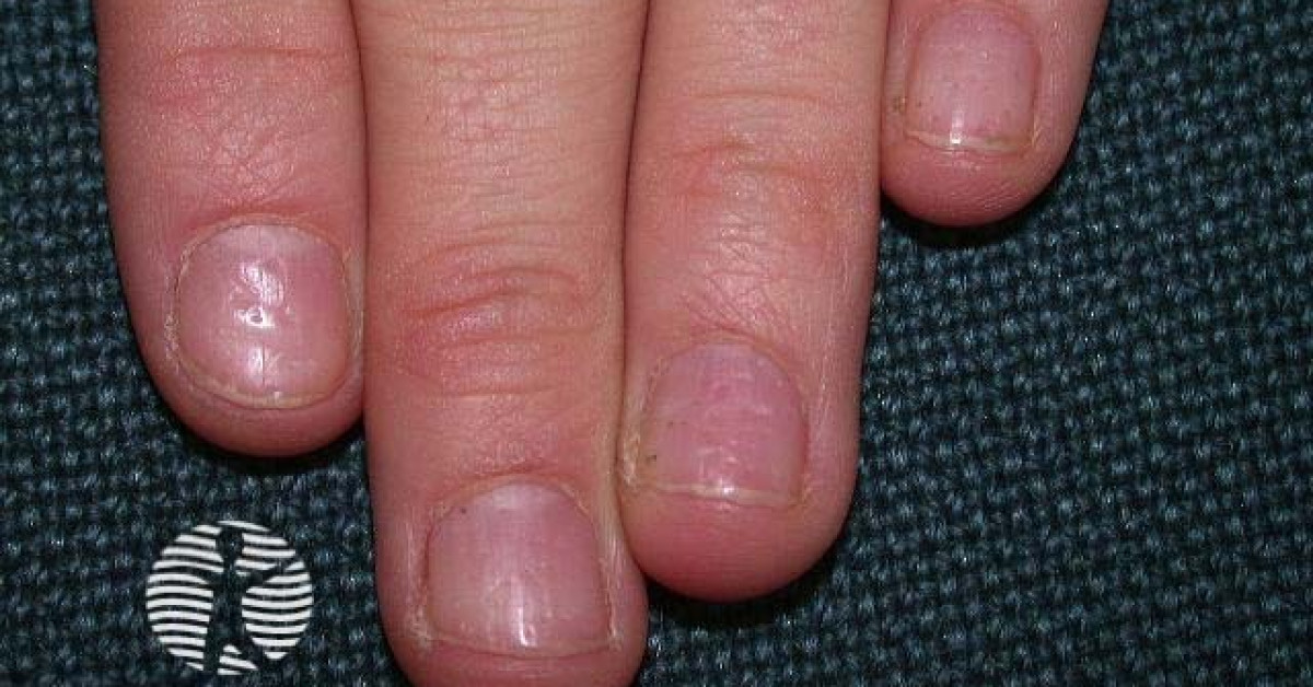 Nail psoriasis image