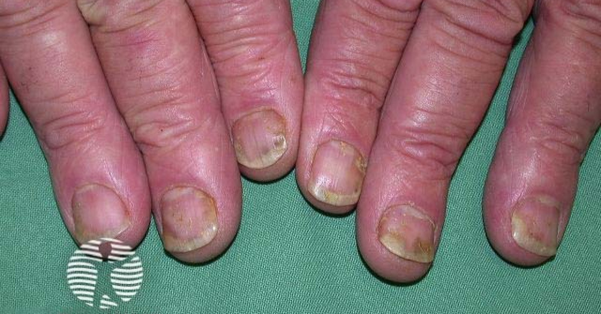 Nail psoriasis image