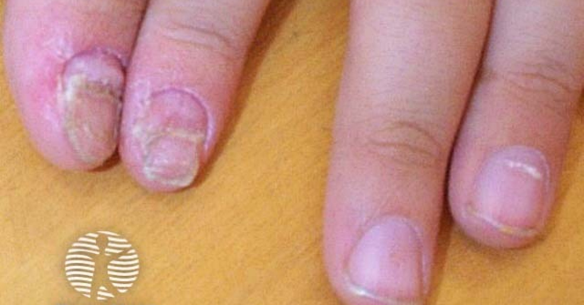 Nail psoriasis image