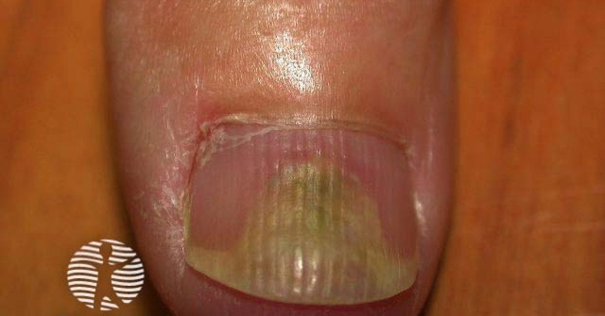 Nail psoriasis image