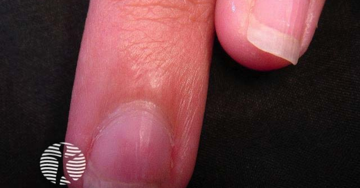 Nail psoriasis image