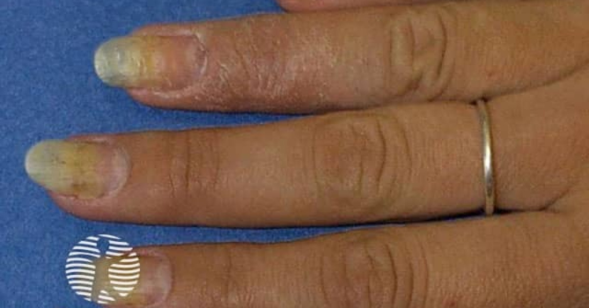 Nails in psoriasis image