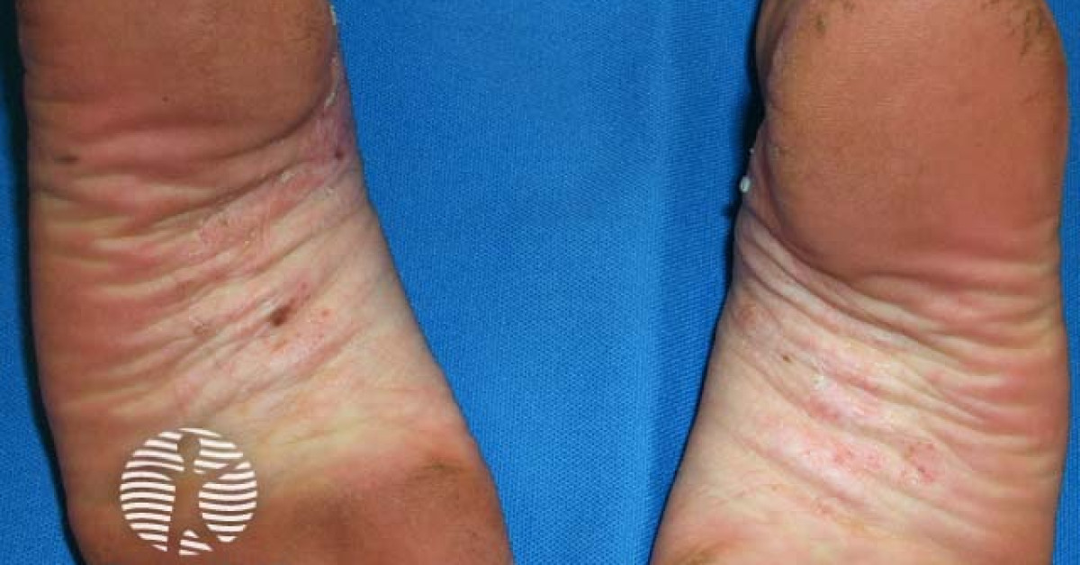 Palmoplantar psoriasis image