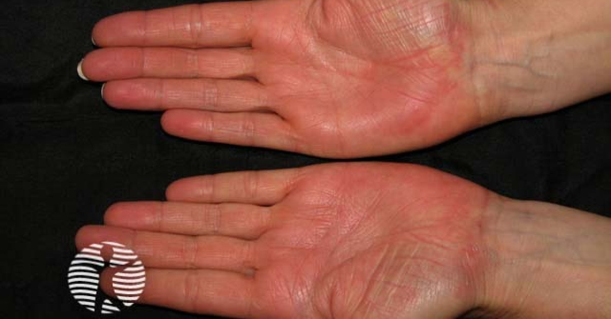 DermNet® - Palmoplantar psoriasis image
