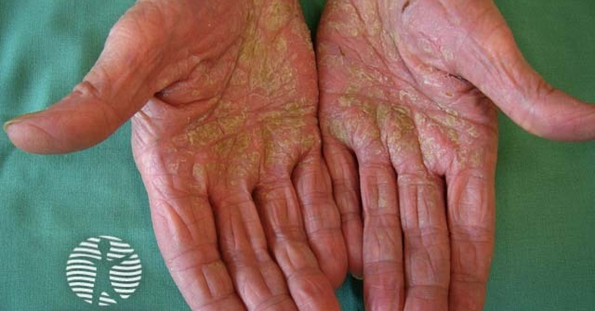 Palmoplantar psoriasis image