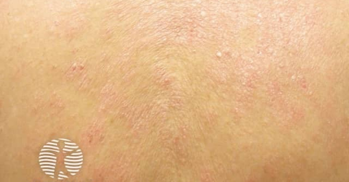 Pityriasiform seborrhoeide image