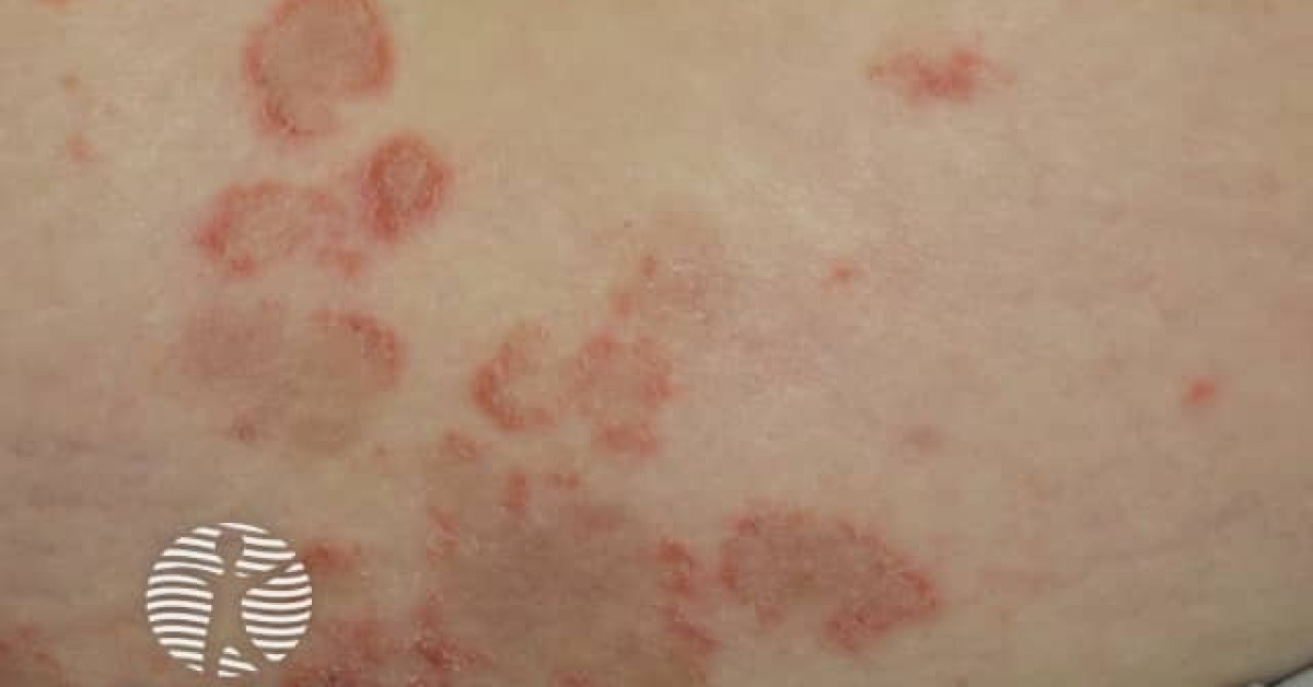 Pityriasiform seborrhoeide image