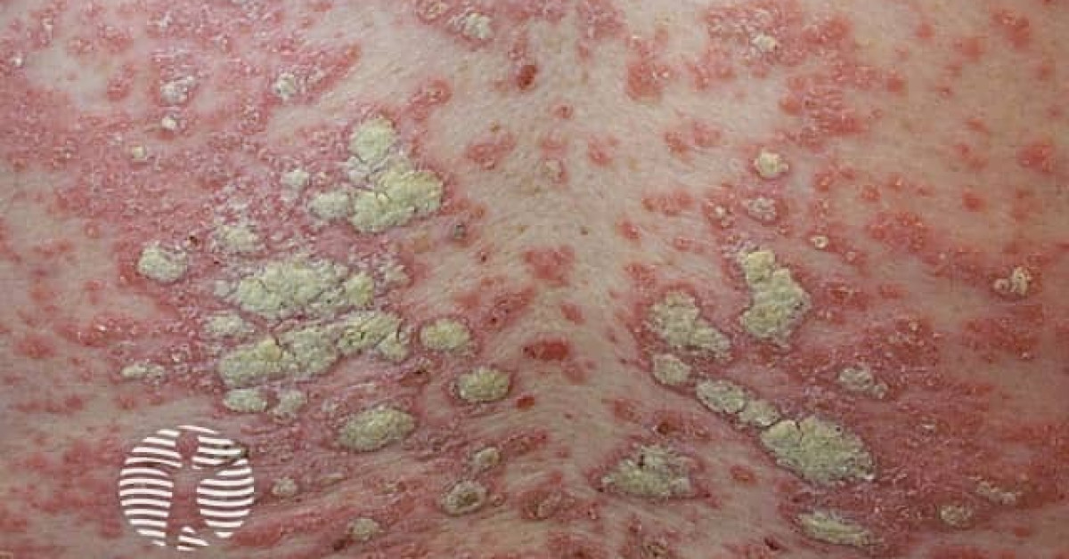 Chronic plaque psoriasis image