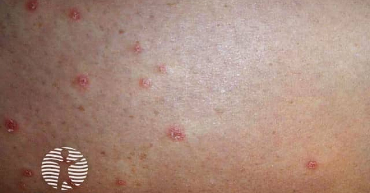 Pityriasis lichenoides chronica image