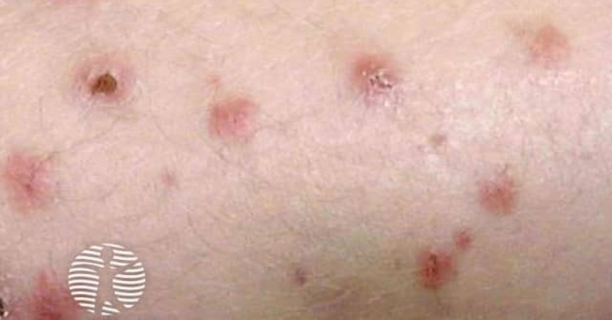 Pityriasis lichenoides et varioliformis acuta image