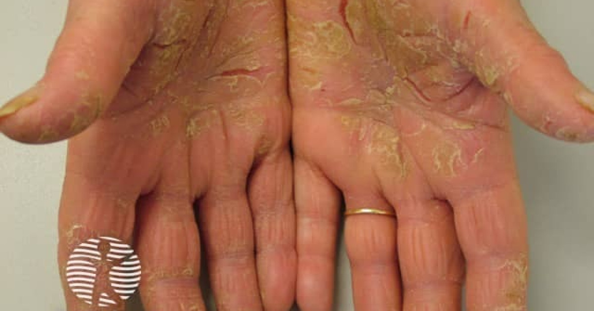 Palmoplantar psoriasis image