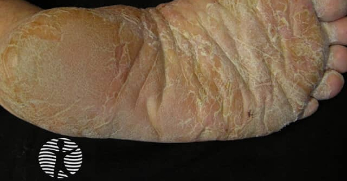 Palmoplantar psoriasis image