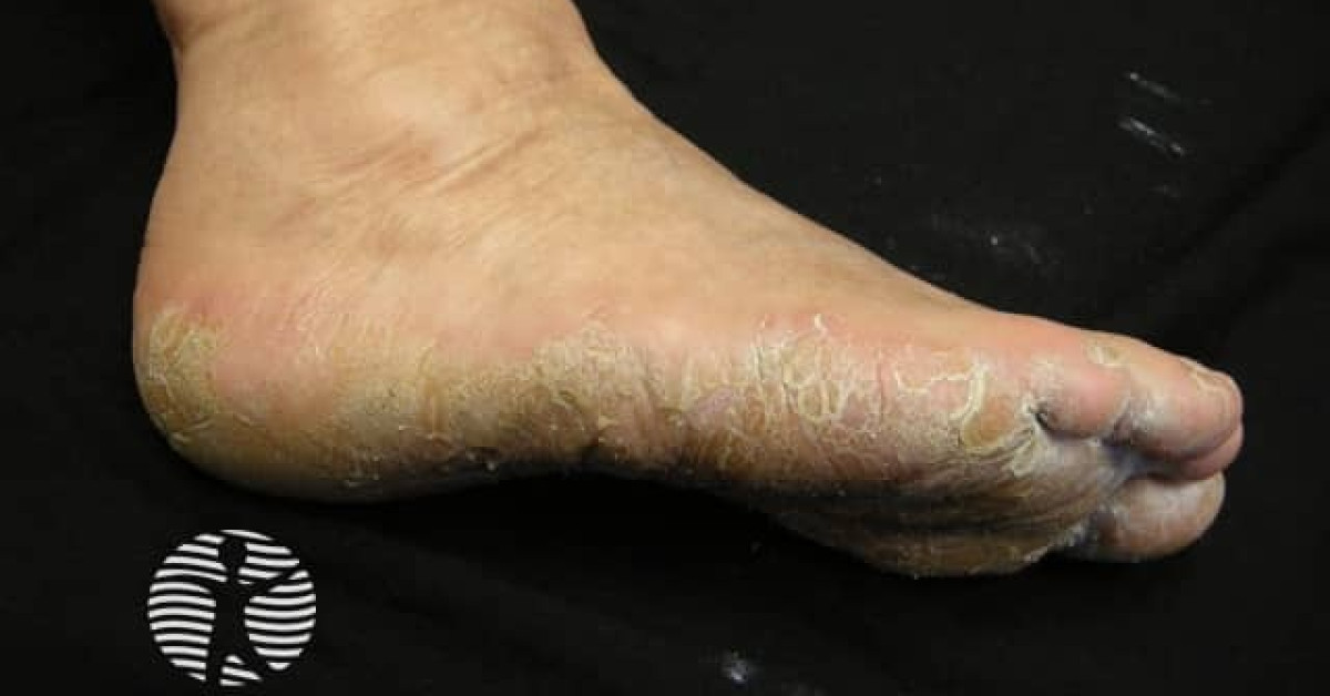 Palmoplantar psoriasis image