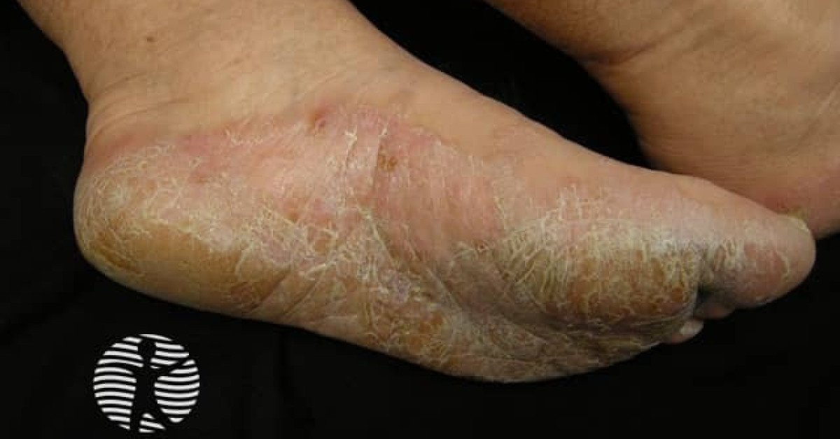 Palmoplantar psoriasis image