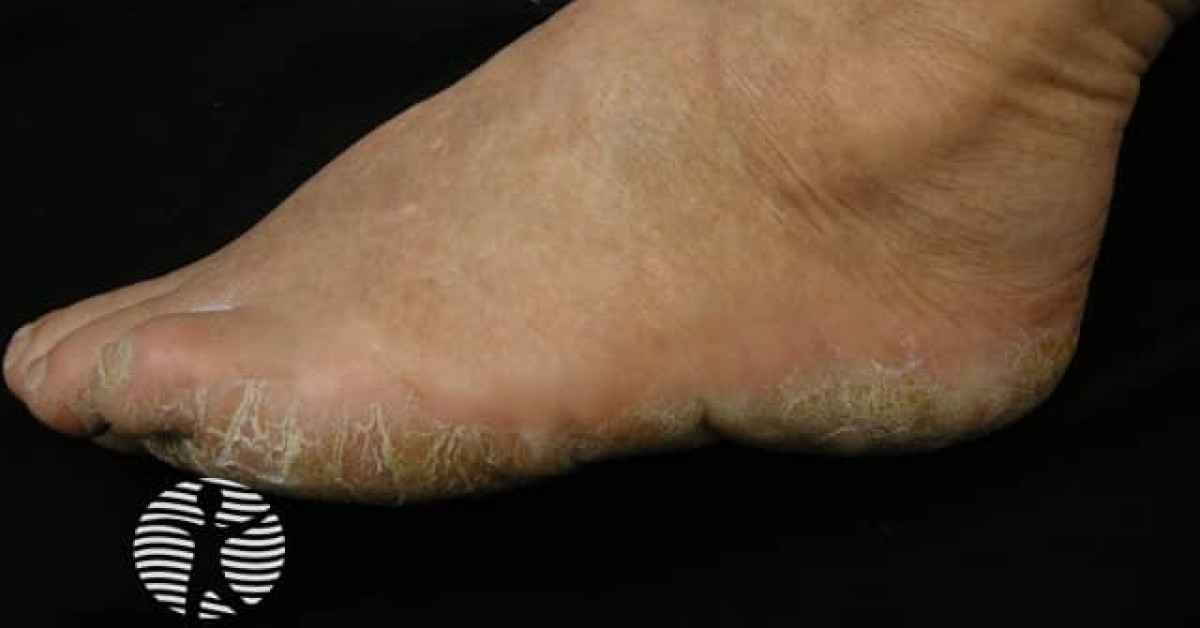 Palmoplantar psoriasis image
