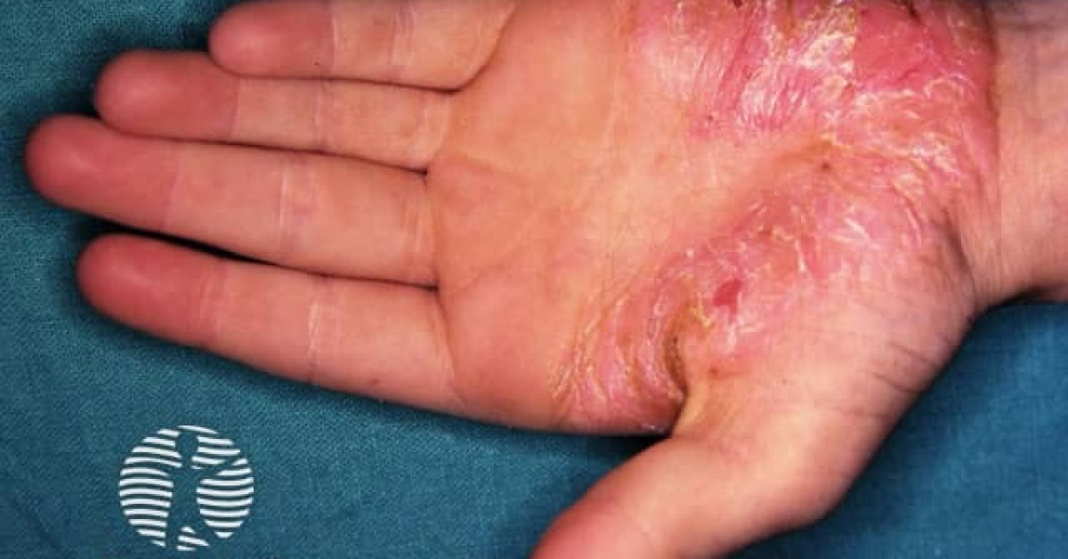 Palmoplantar psoriasis image