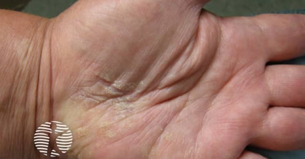 Palmoplantar psoriasis image