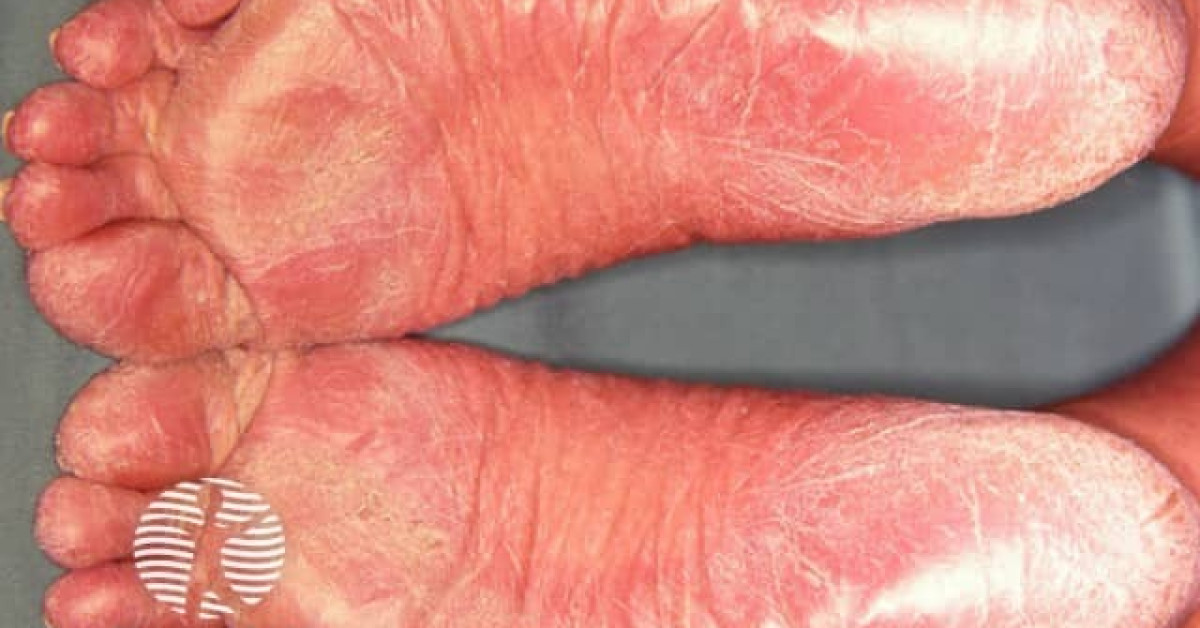 Palmoplantar psoriasis image