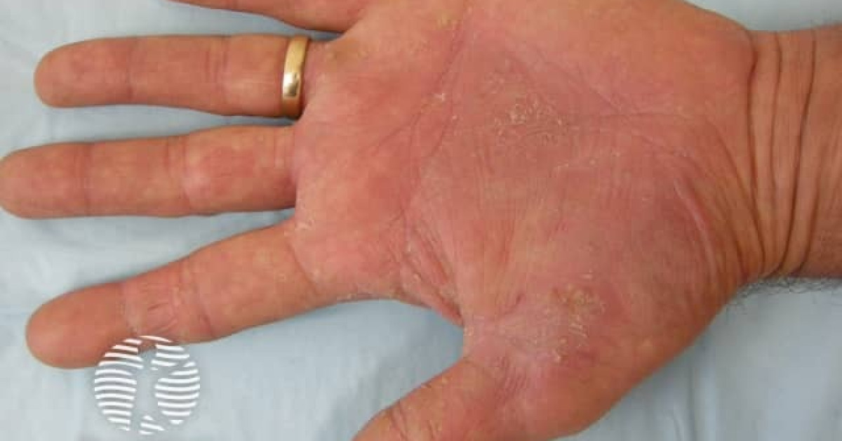 Palmoplantar psoriasis image