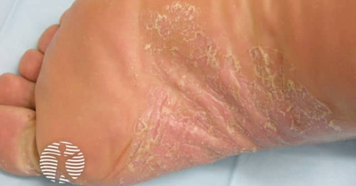 Palmoplantar psoriasis image
